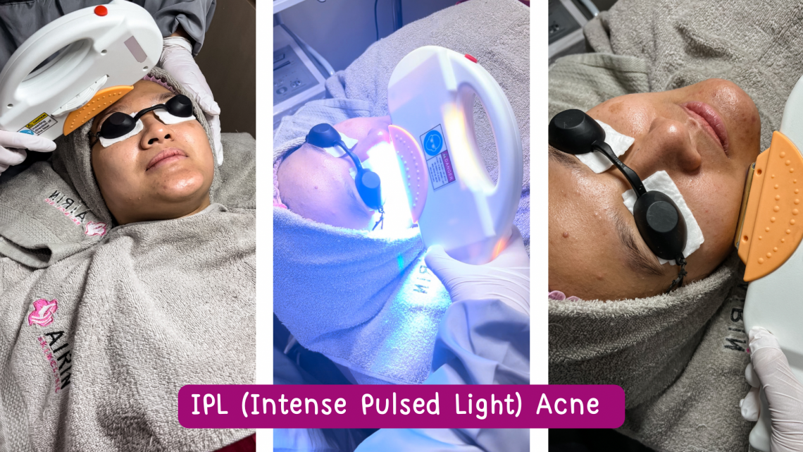Review Treatment IPL ACNE dan ELECTROCAUTER di AIRIN SKIN CLINIC ...